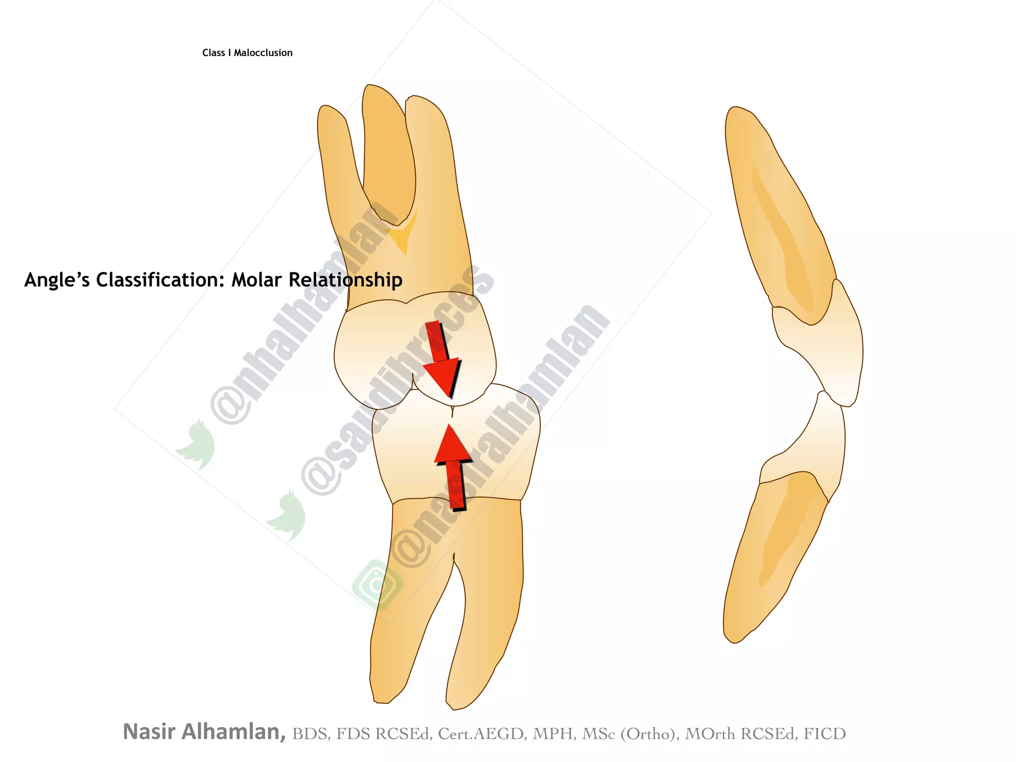 The relation between skeletal pattern and malocclusion (Incisor and ...