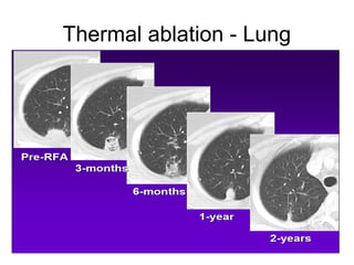Thermal ablation techniques in interventional radiology | PPTX