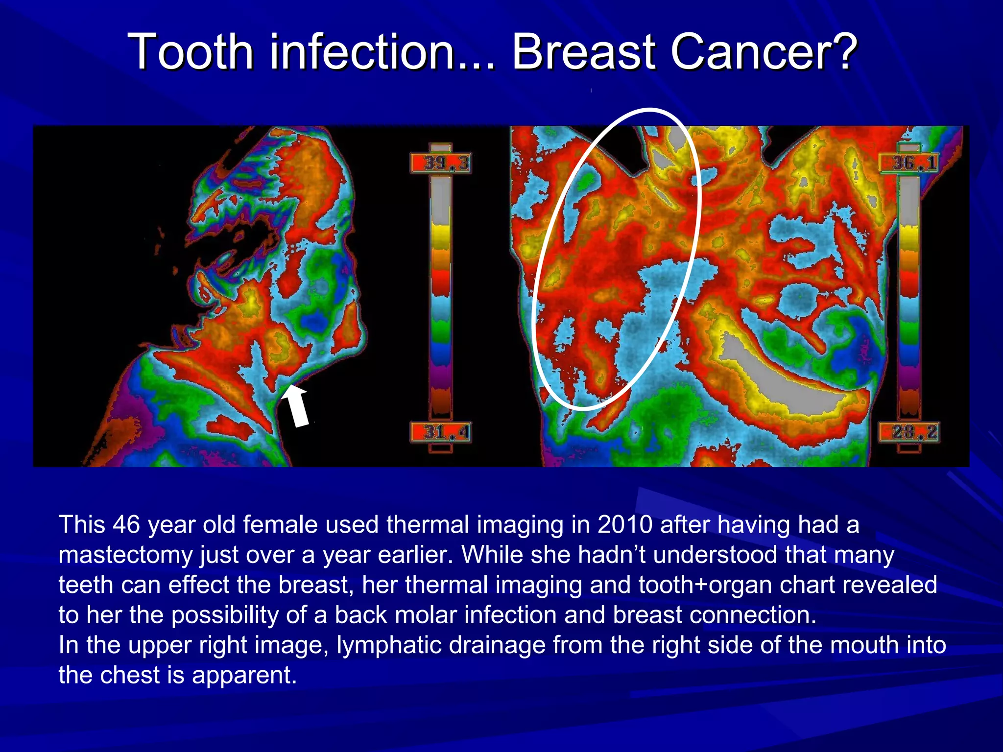 Thermal Imaging Examples of Dental Issues | PPT