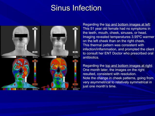 Thermal Imaging Examples of Dental Issues | PPT