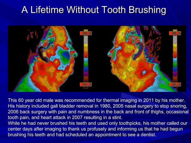 Thermal Imaging Examples of Dental Issues | PPT