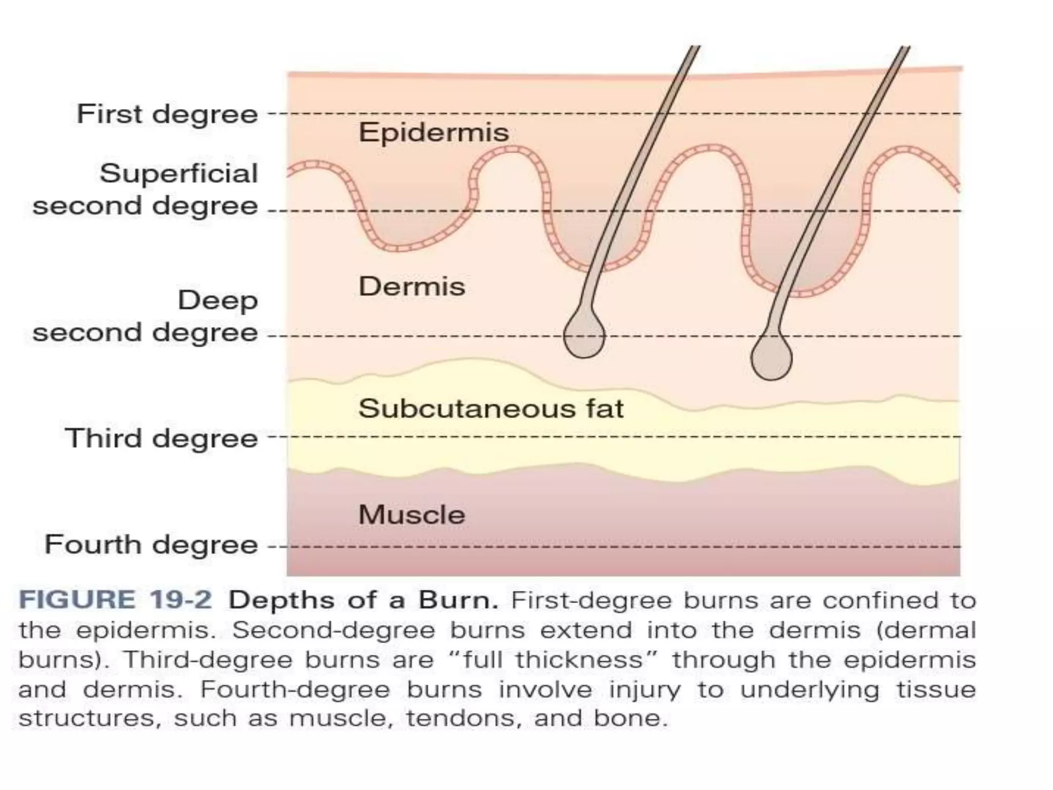 Thermal burns | PPTX