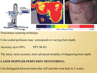 Thermal burns | PPTX