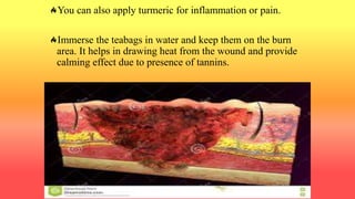 Thermal burns with anatomy of skin. | PPTX