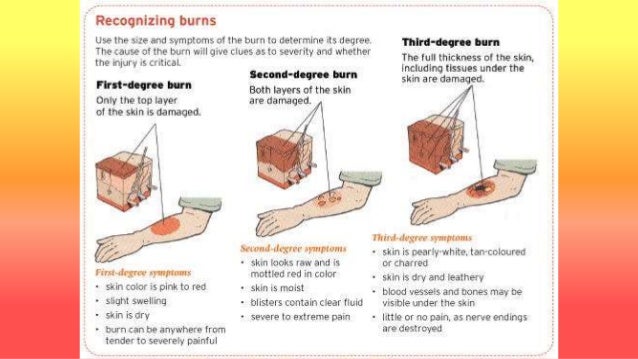 Thermal burns with anatomy of skin.