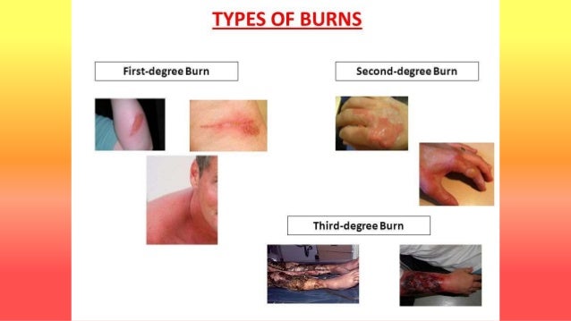 Thermal burns with anatomy of skin.