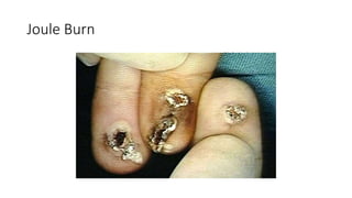 Thermal injuries | PPTX