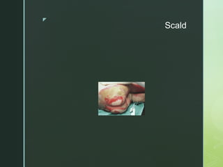 THERMAL INJURIES including hyperthermia and hypothermal injuries | PPT