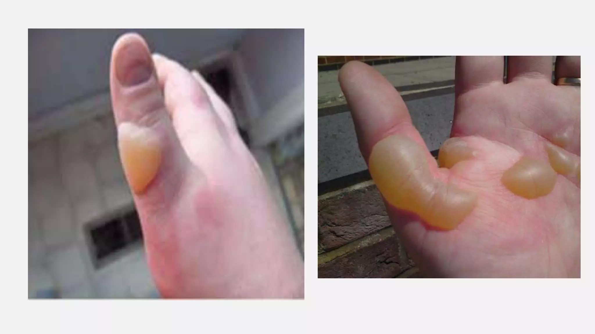 Thermal injuries-72.pptx