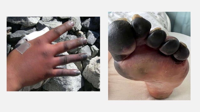 Thermal injuries-72.pptx