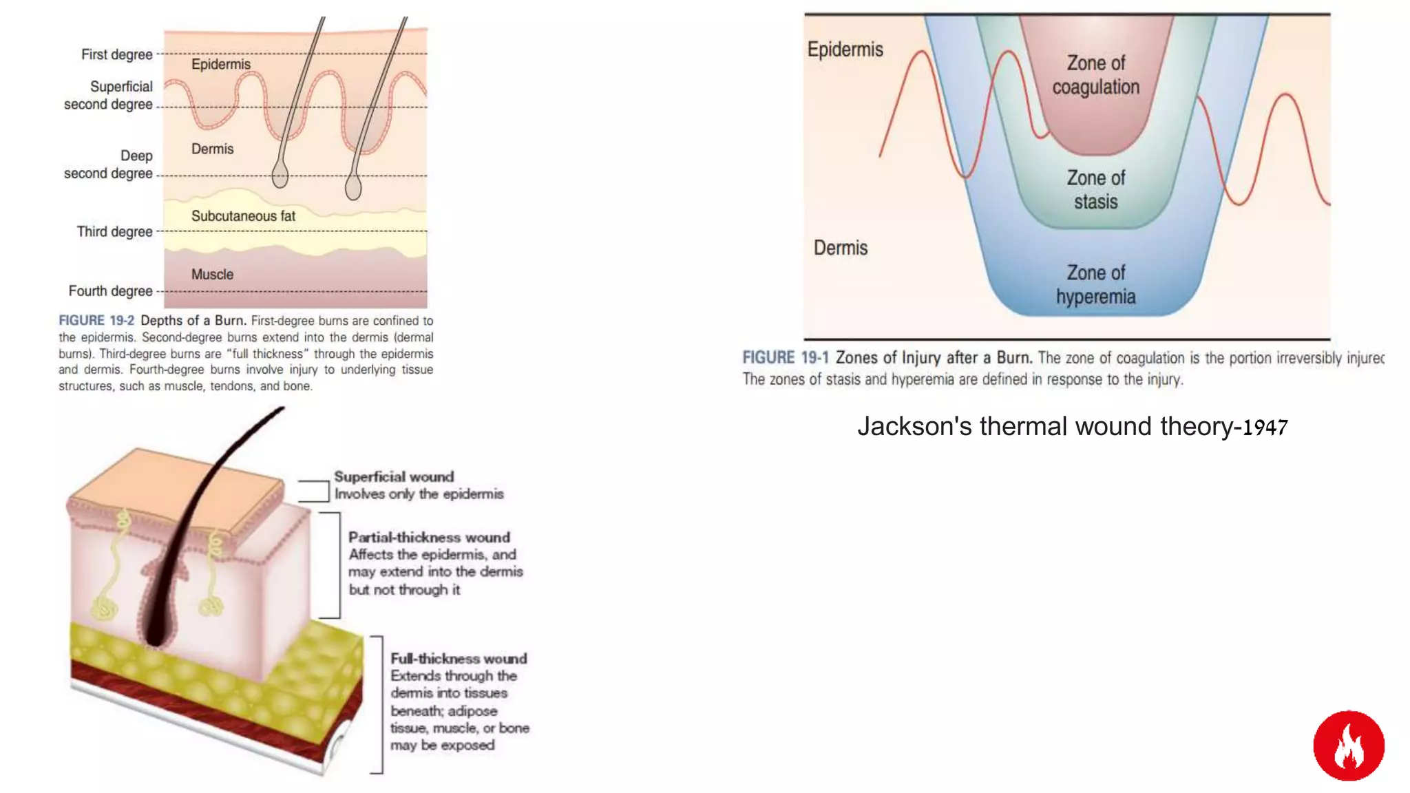 Thermal injuries -plastic surgery | PPTX