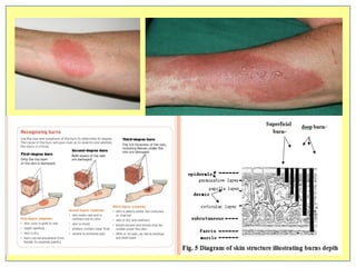 THERMAL INJURIES Forensic Medicine 12025 | PPTX