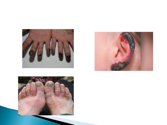 Thermal injury | PPTX