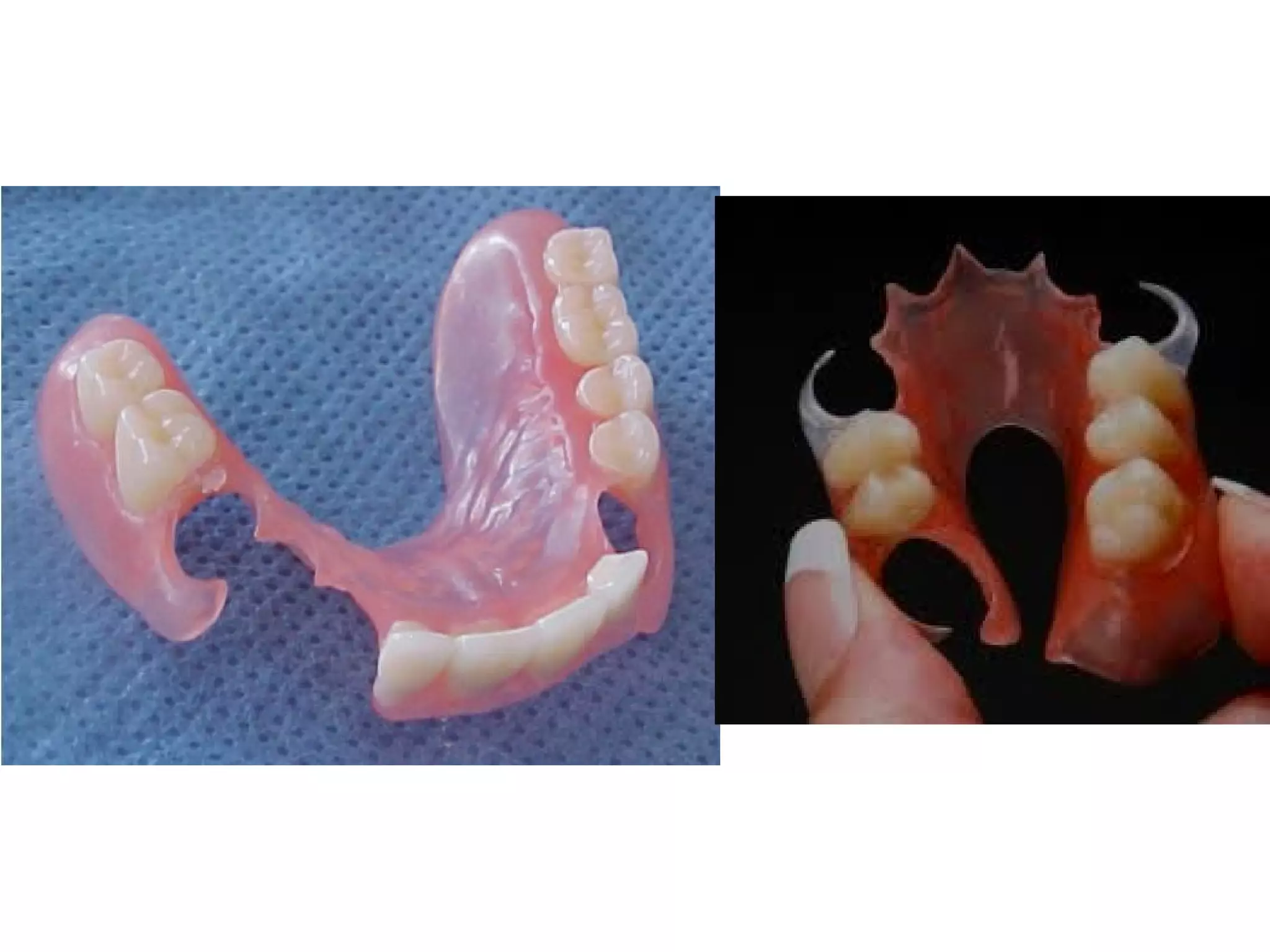 flexible dentures ( acetal resin ) | PPT