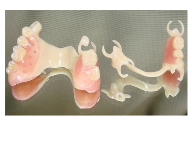 flexible dentures ( acetal resin ) | PPT