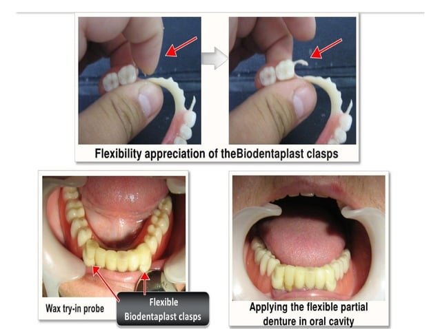flexible dentures ( acetal resin ) | PPT