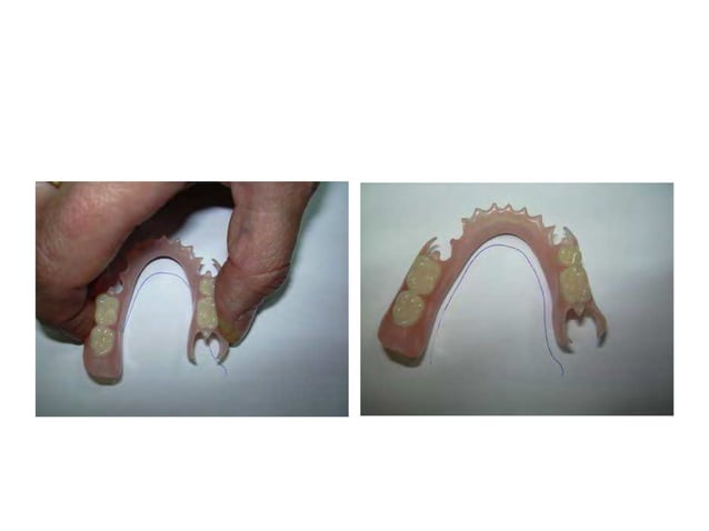 flexible dentures ( acetal resin ) | PPT