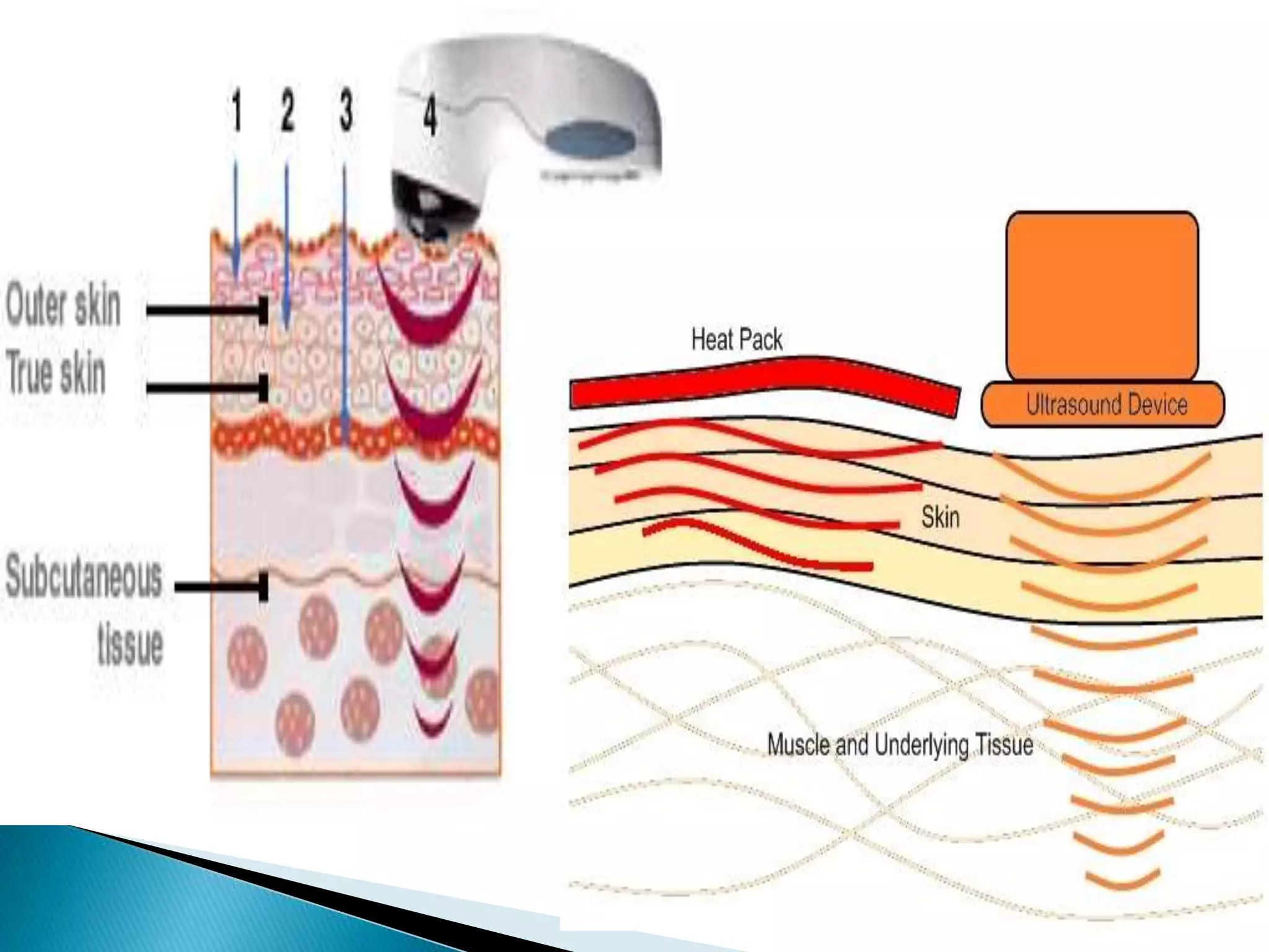 Thermotherapy | PPTX