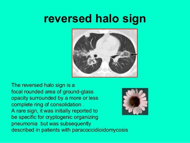The road to HRCT evaluation of pediatric diffuse lung diseases .part 1