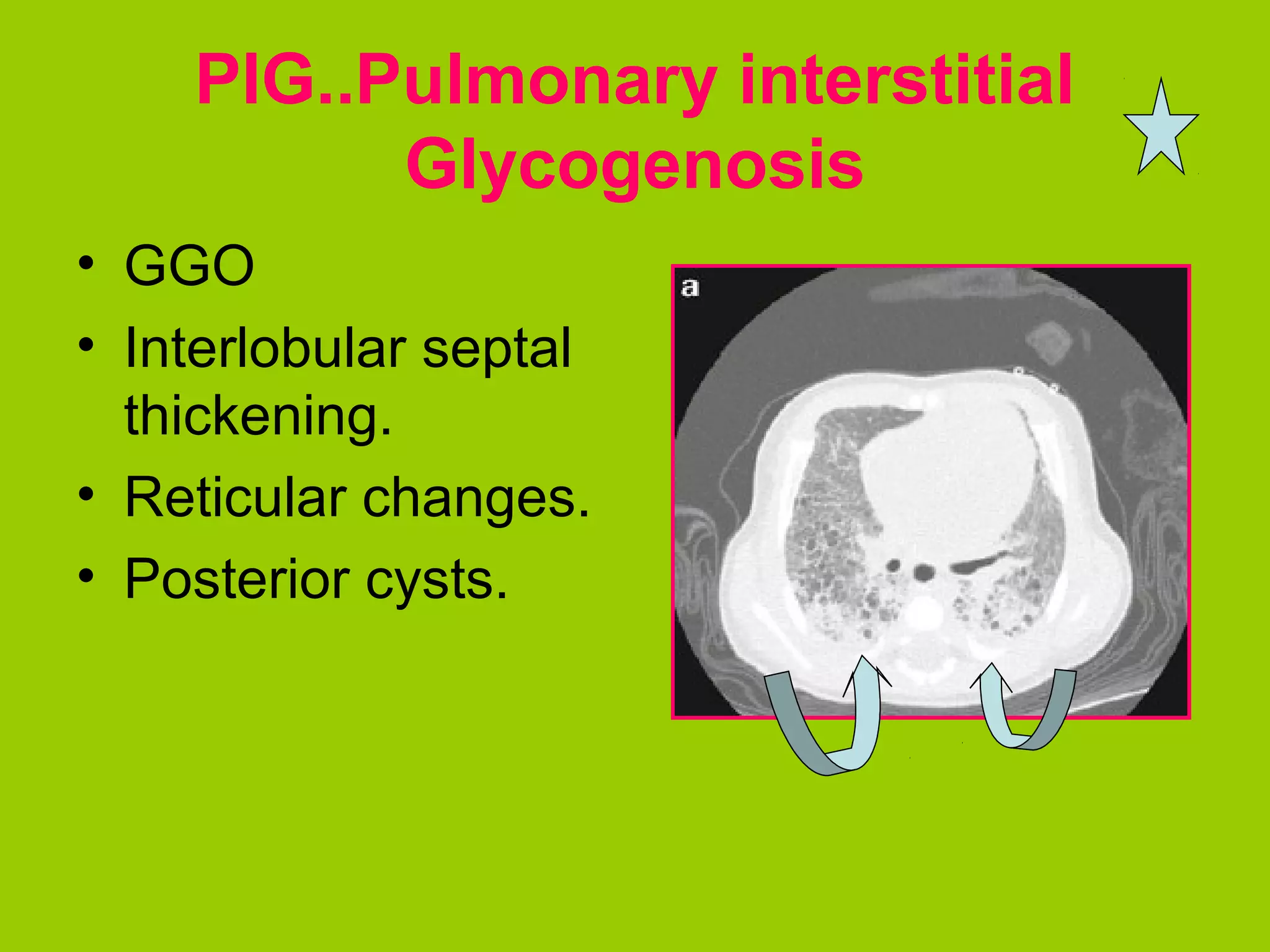 The road to HRCT evaluation of pediatric diffuse lung diseases.part 2 | PPT