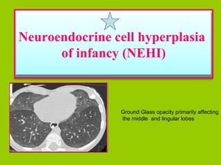 The road to HRCT evaluation of pediatric diffuse lung diseases.part 2 | PPT