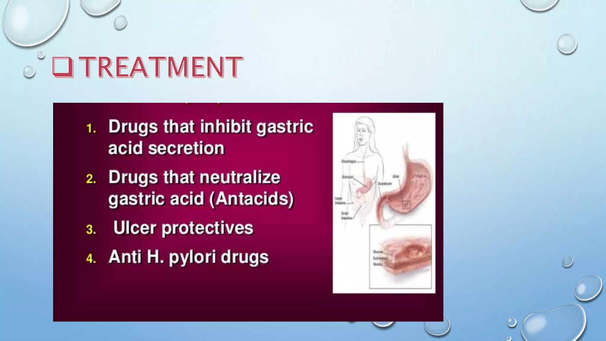 Peptic Ulcer | PPT