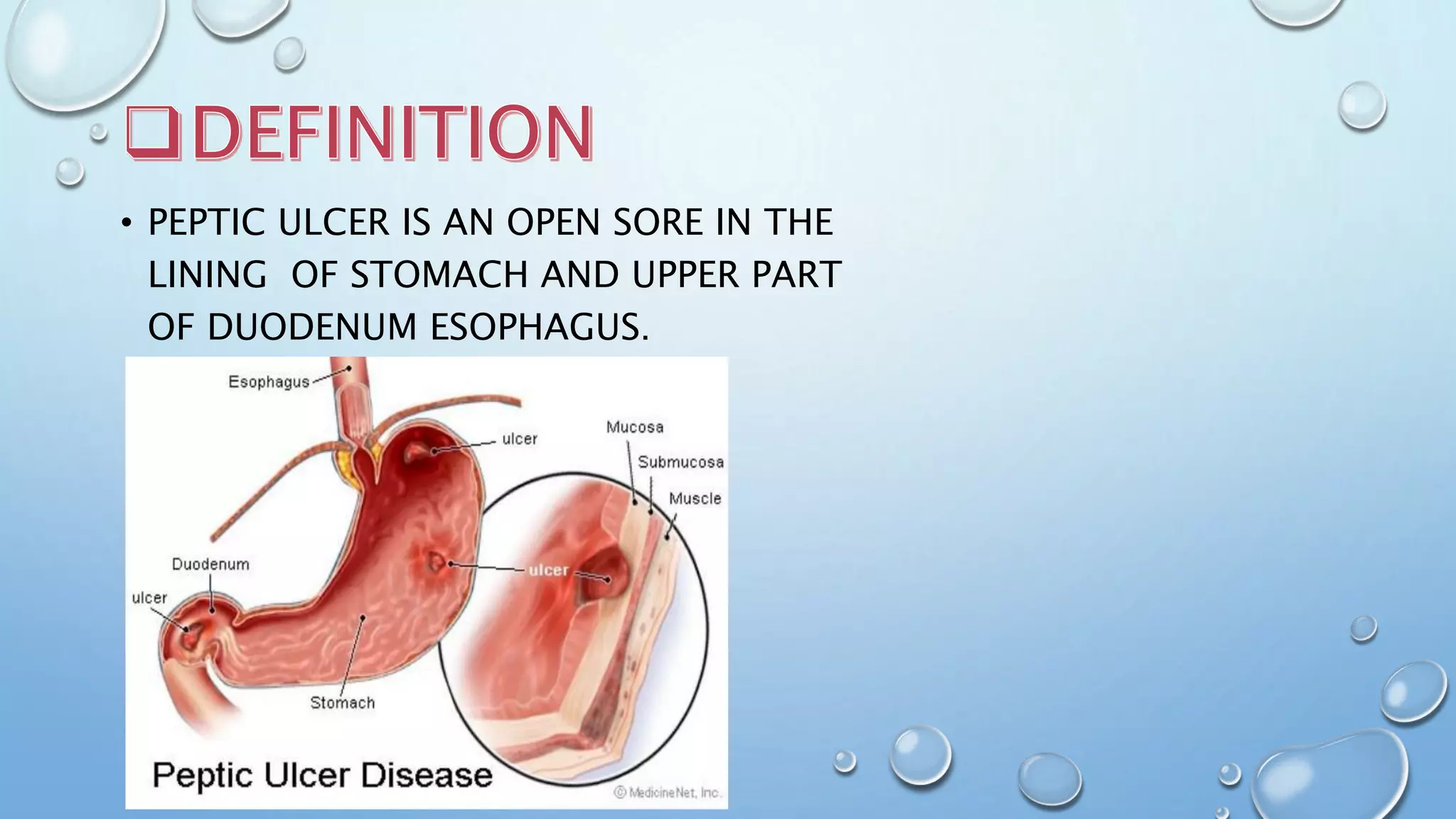 Peptic Ulcer | PPT