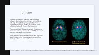The Role of DaT Scan in Diagnosing Parkinson Disease | PPTX