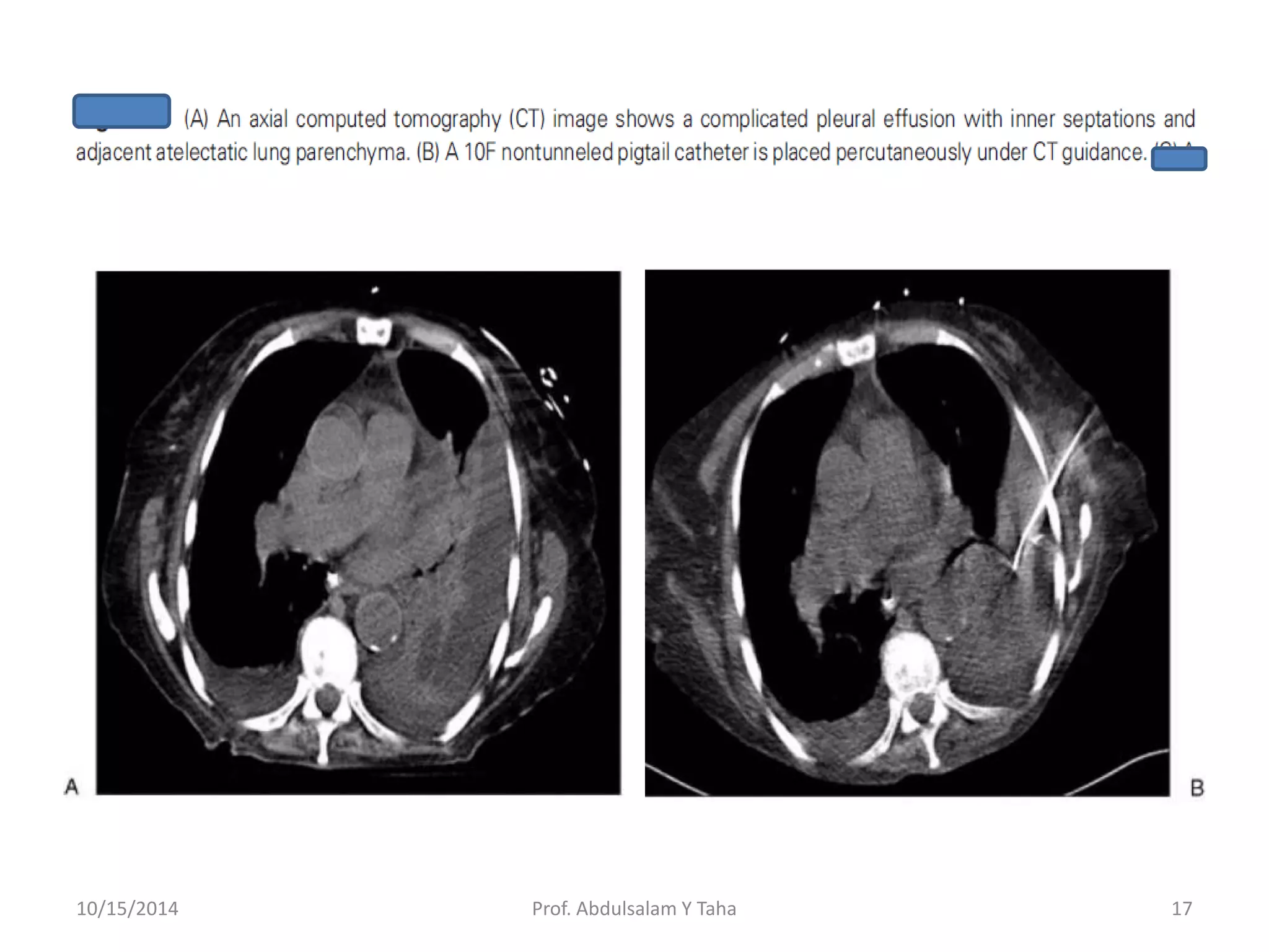 The role of interventional radiology in management of Plural effusion ...
