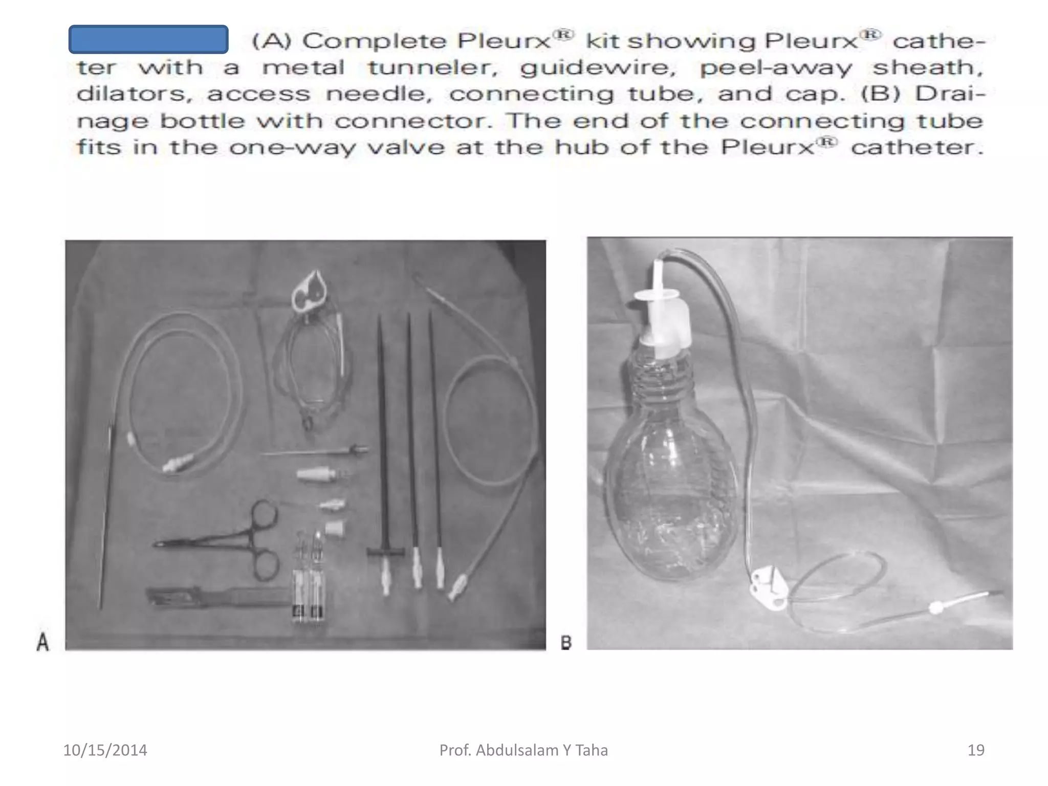 The role of interventional radiology in management of Plural effusion ...