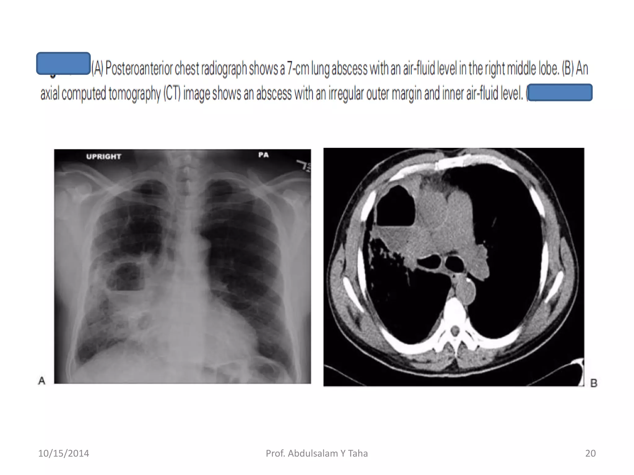 The role of interventional radiology in management of Plural effusion ...