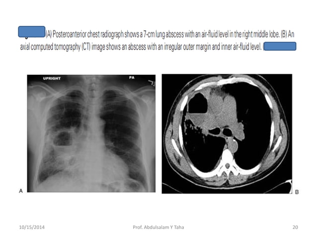 The role of interventional radiology in management of Plural effusion ...