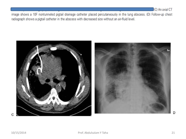 The role of interventional radiology in management of Plural effusion ...