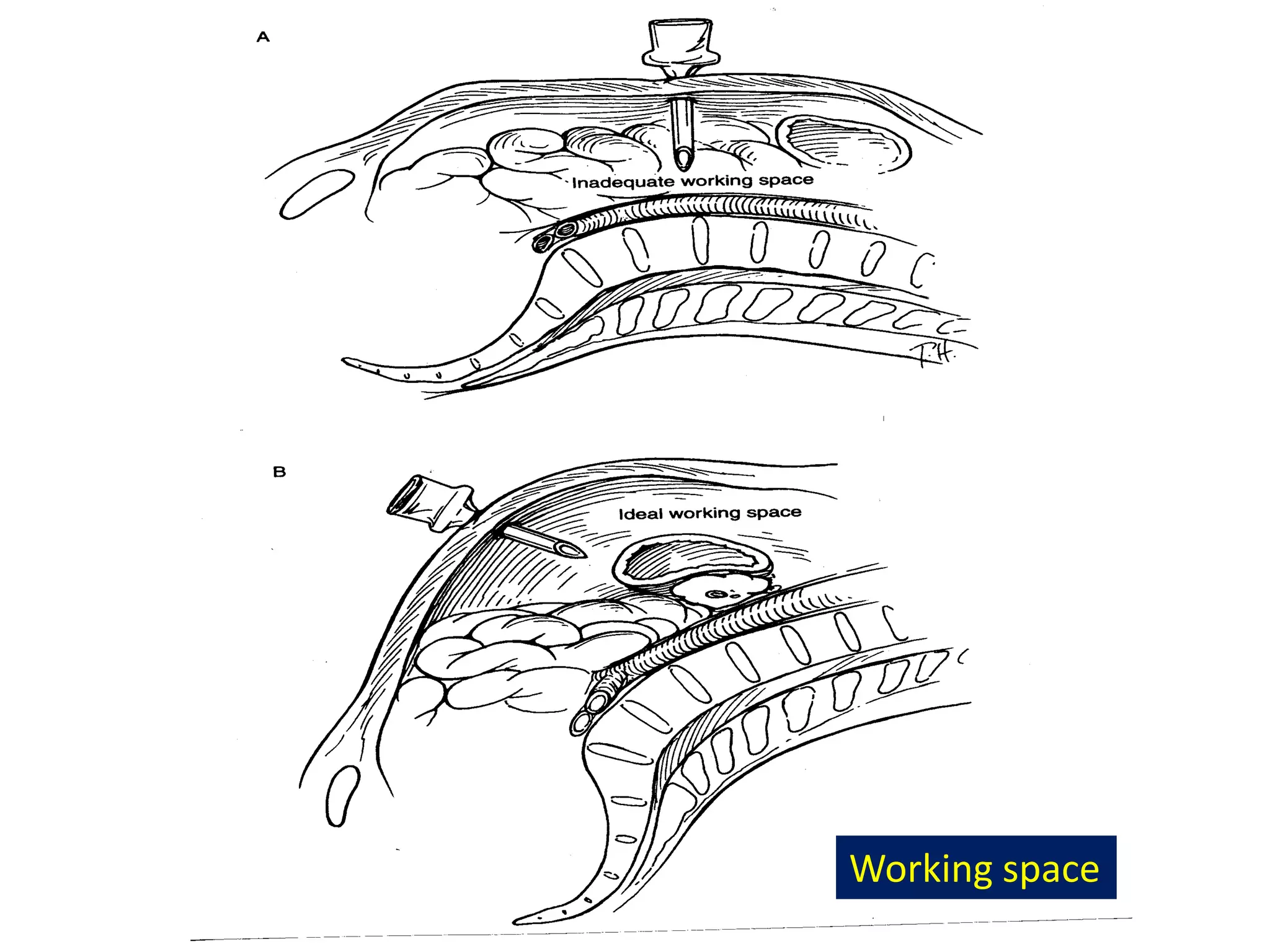 The role of laparoscopy in acute care surgery | PPTX