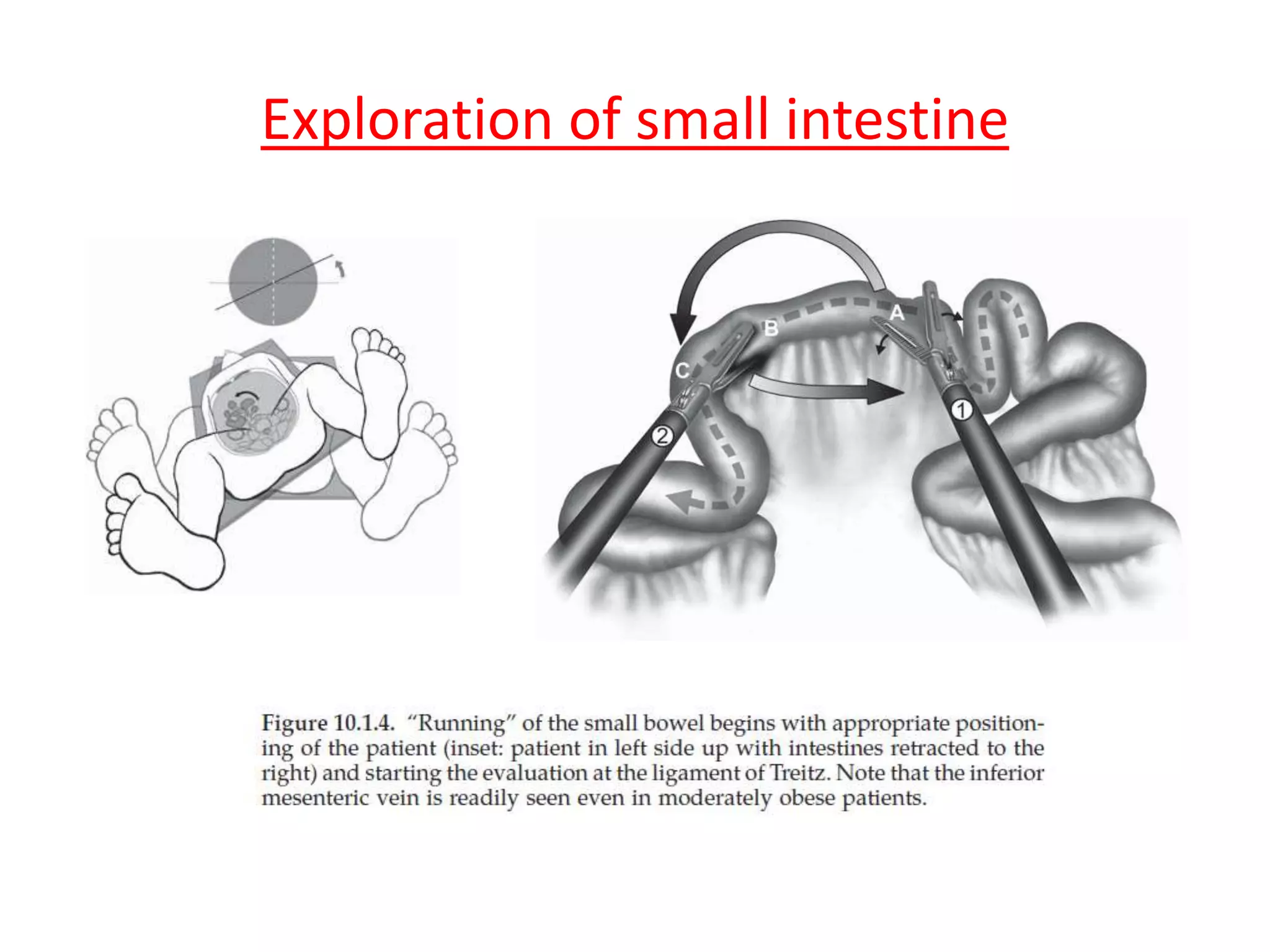 The role of laparoscopy in acute care surgery | PPTX