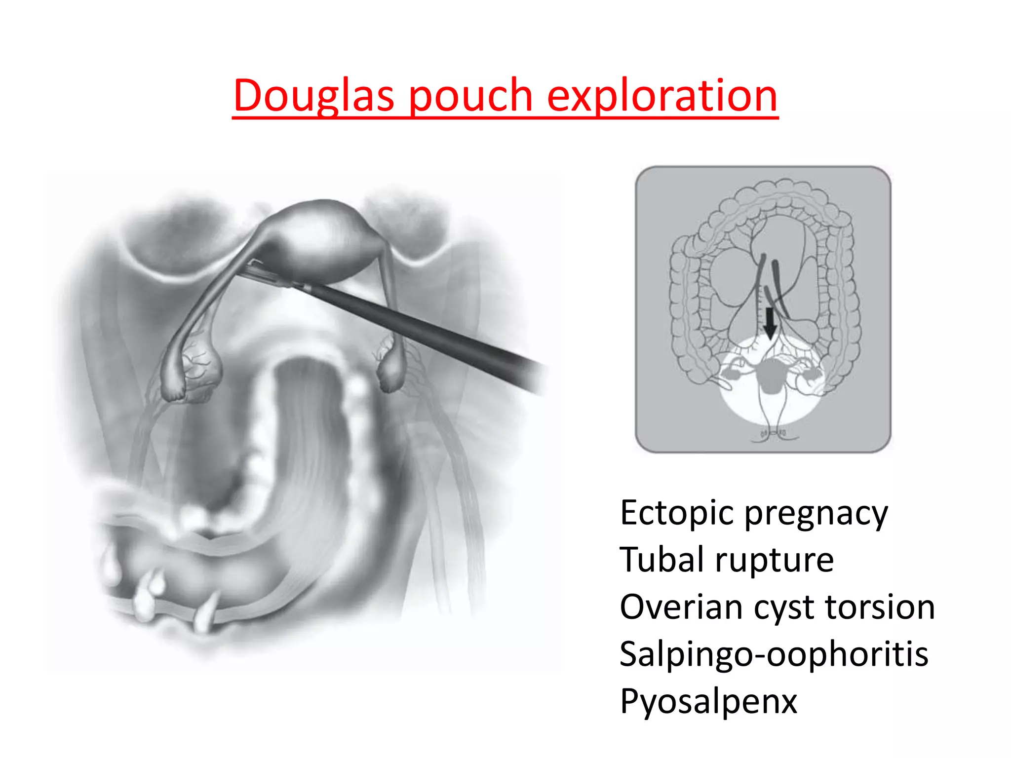 The role of laparoscopy in acute care surgery | PPTX