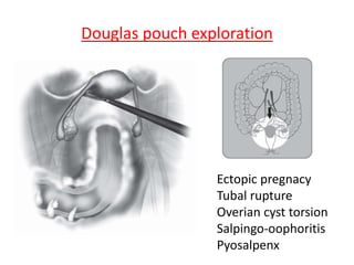 The role of laparoscopy in acute care surgery | PPTX