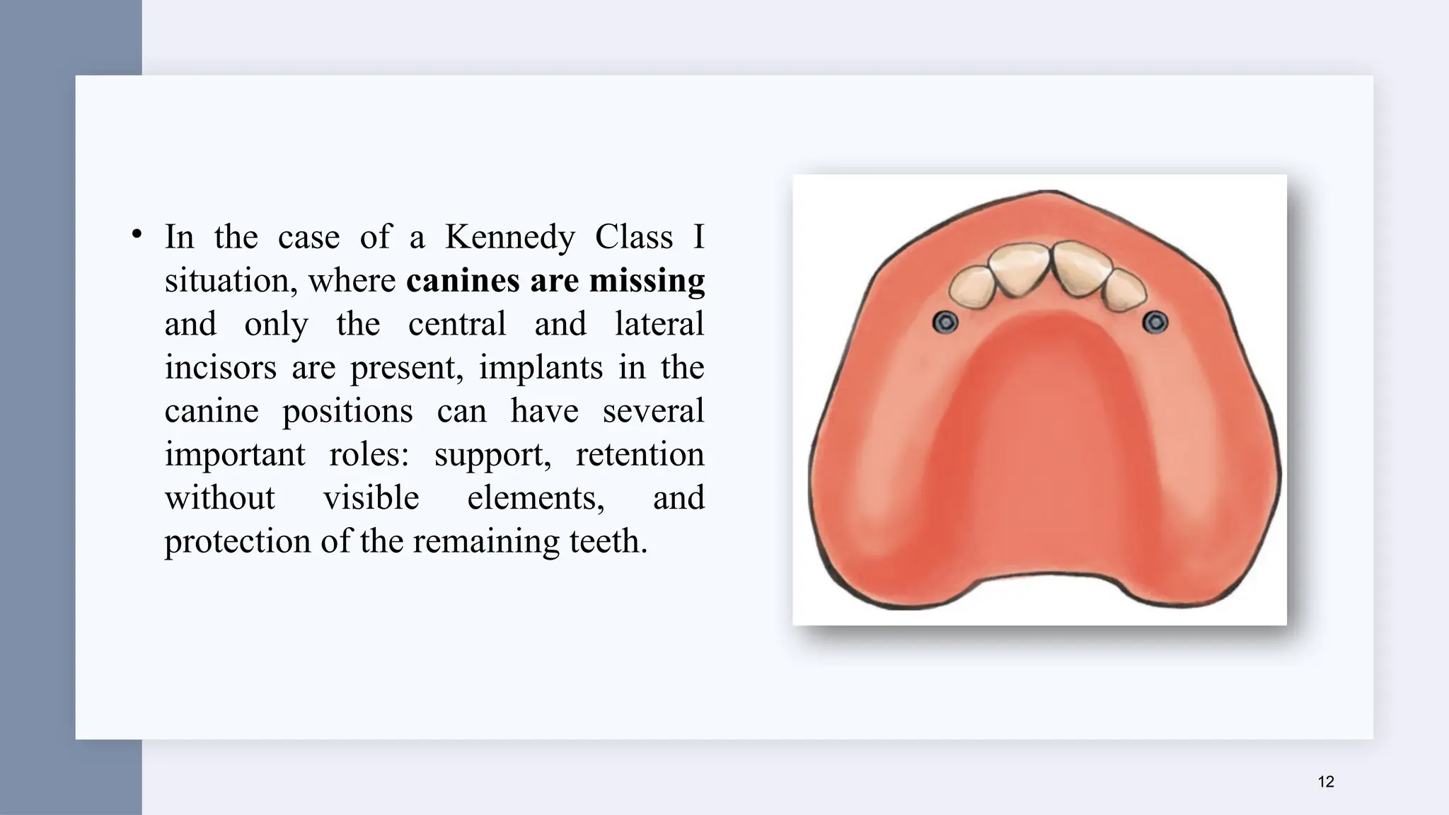 The Role of the Dental Implant in RPD_JC.pptx