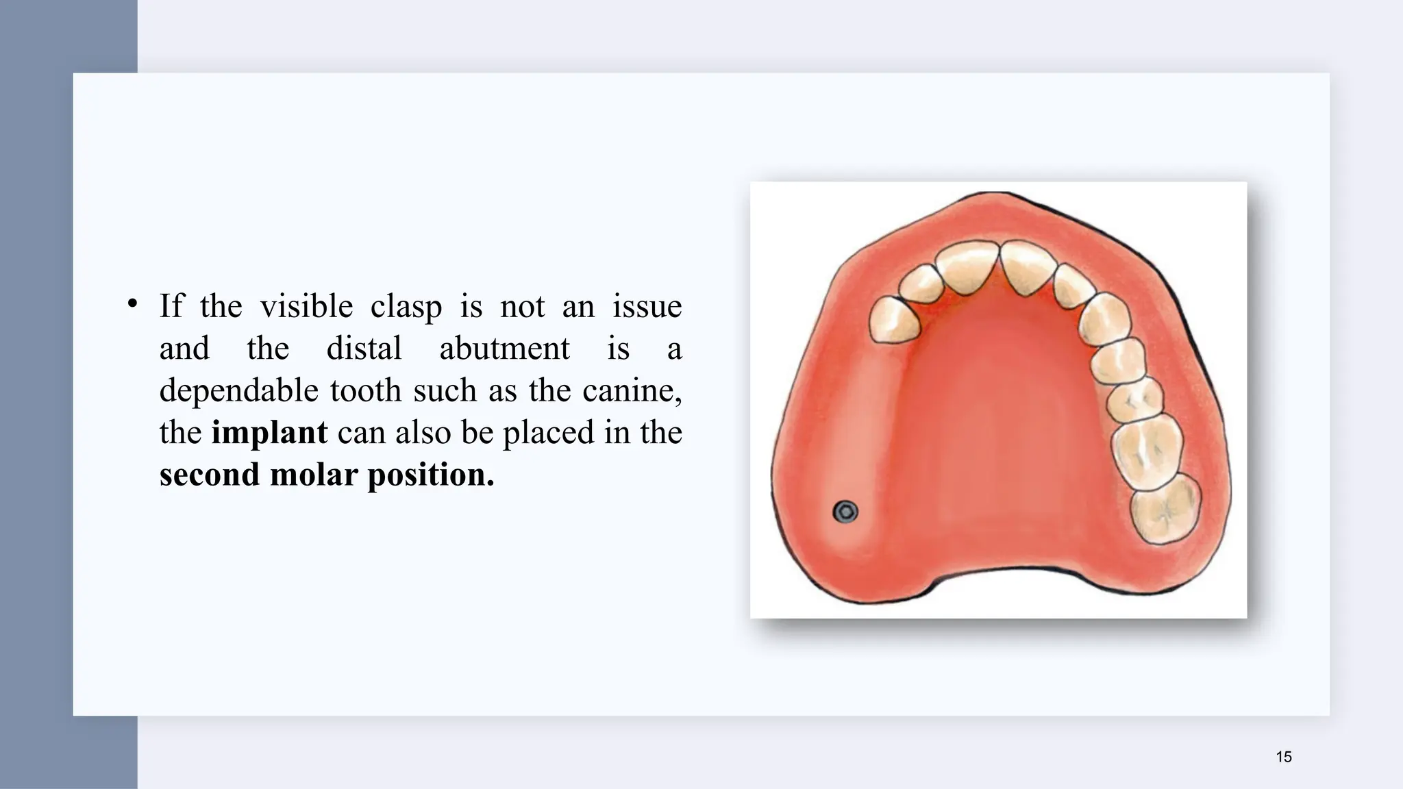 The Role of the Dental Implant in RPD_JC.pptx
