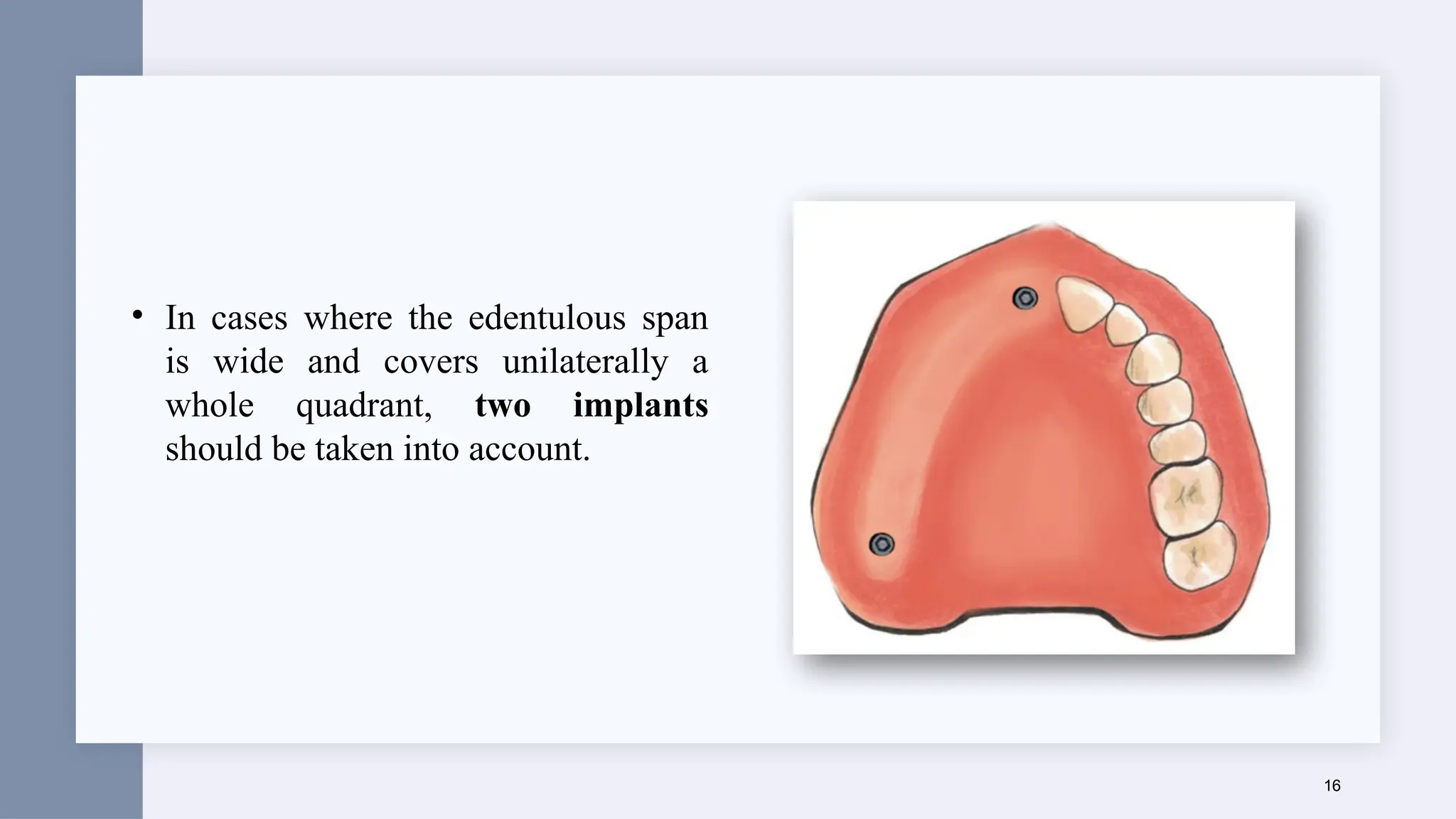 The Role of the Dental Implant in RPD_JC.pptx