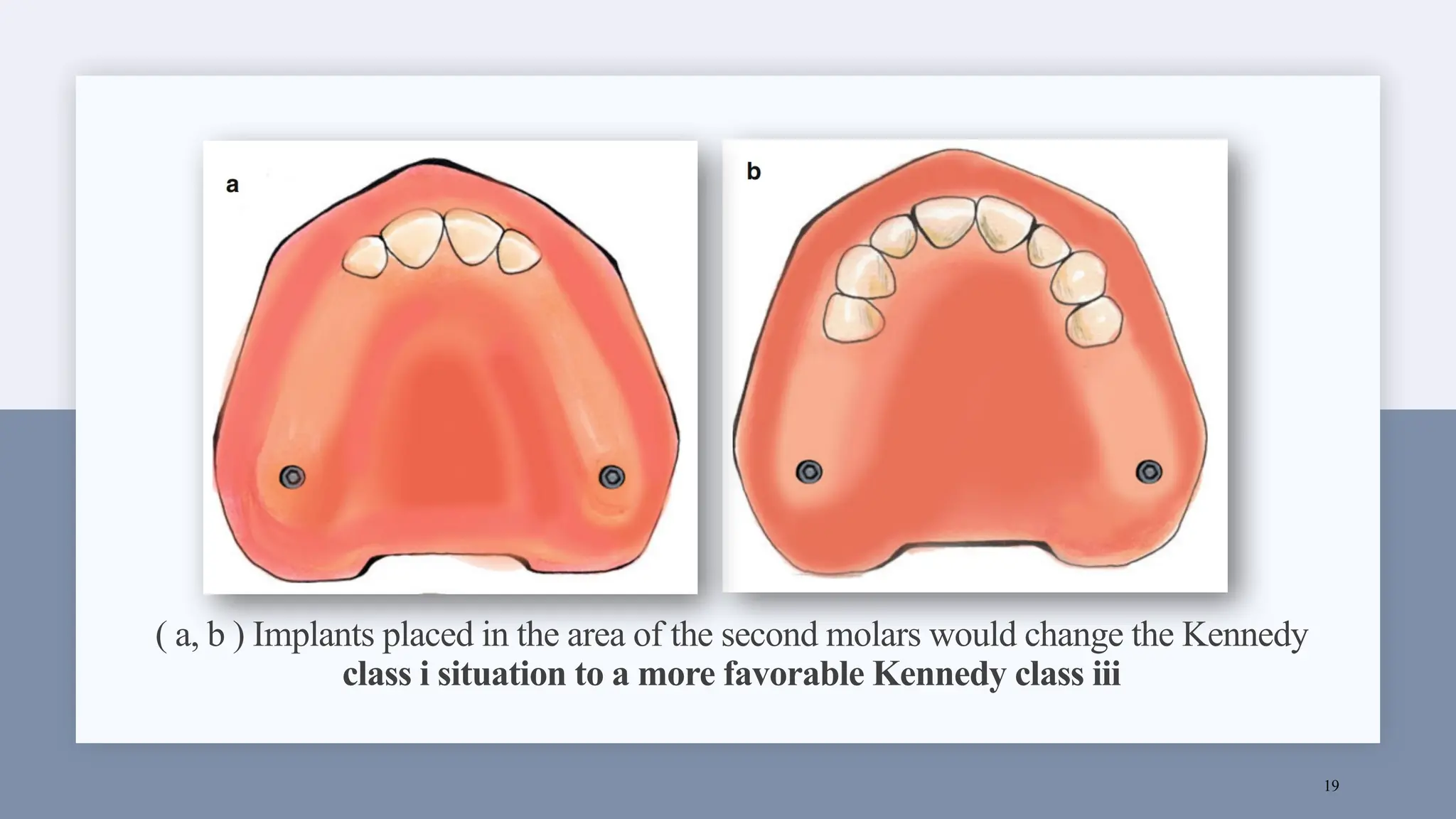 The Role of the Dental Implant in RPD_JC.pptx