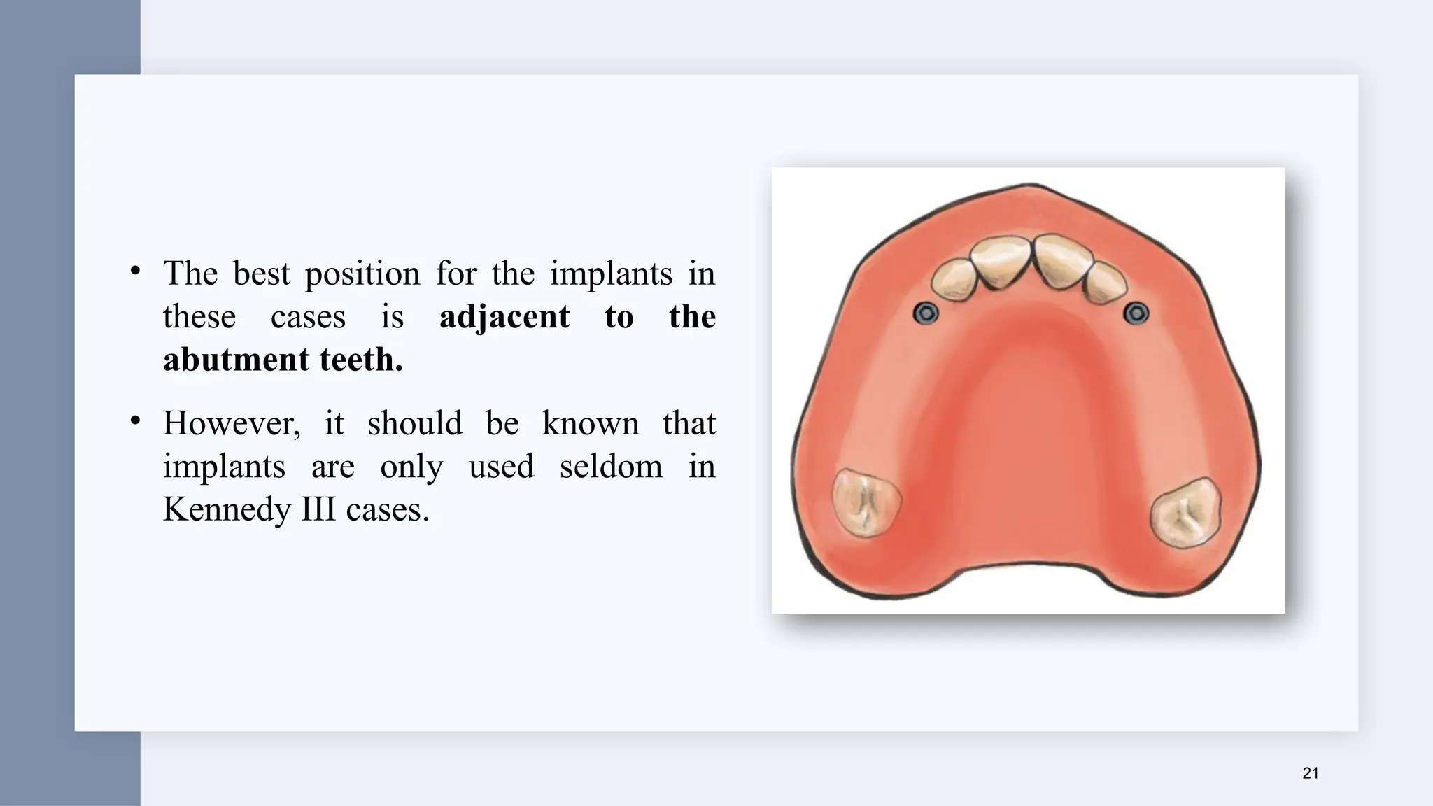 The Role of the Dental Implant in RPD_JC.pptx
