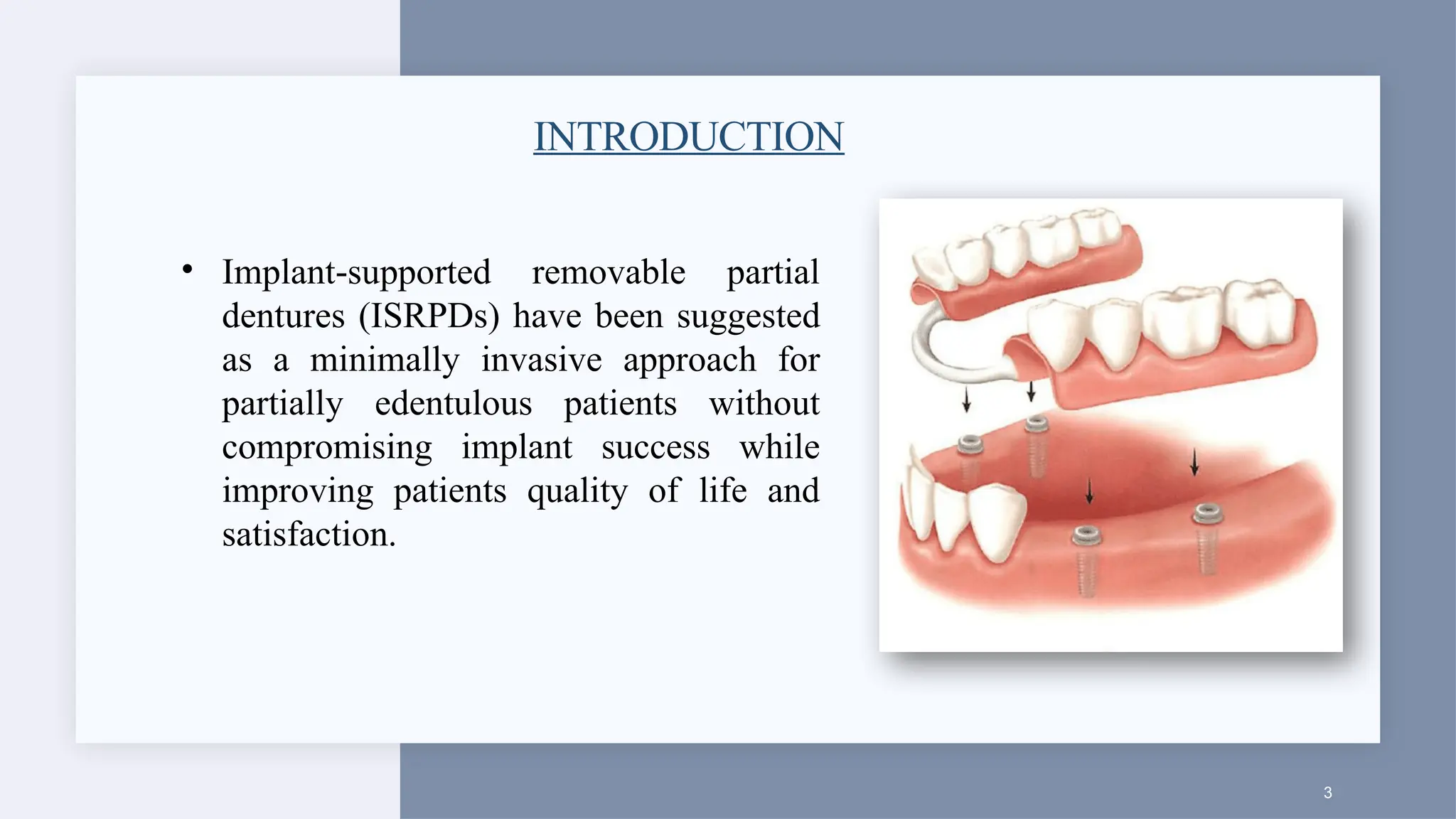 The Role of the Dental Implant in RPD_JC.pptx