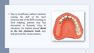 The Role of the Dental Implant in RPD_JC.pptx