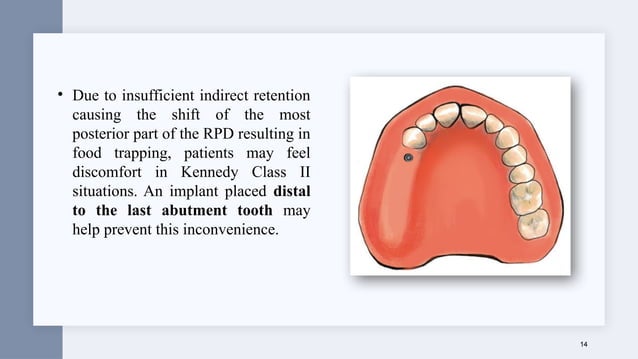 The Role of the Dental Implant in RPD_JC.pptx | Dental Health ...