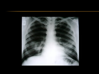 The role of thoracoscopy in the management of | PPT