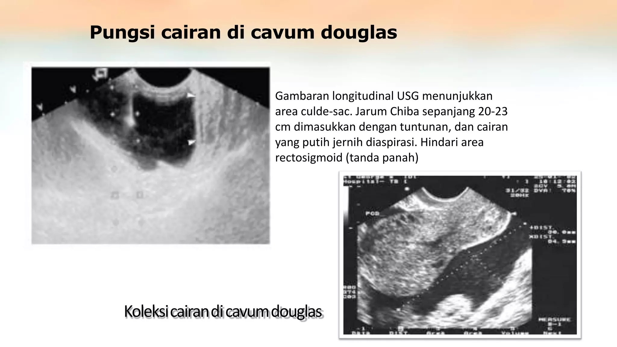 The role of usg tv examination for infertility patient | PPT
