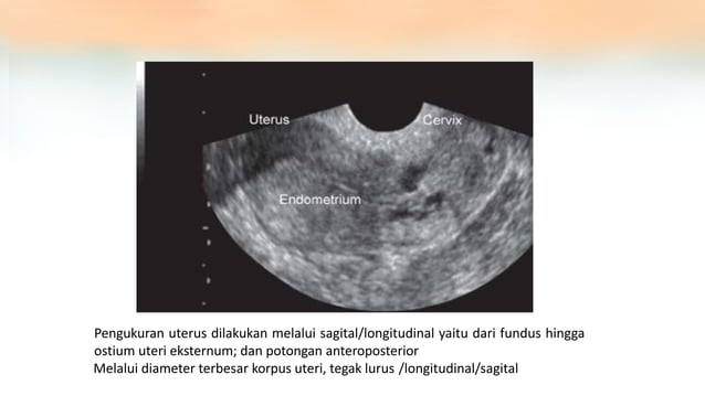 The role of usg tv examination for infertility patient | PPT