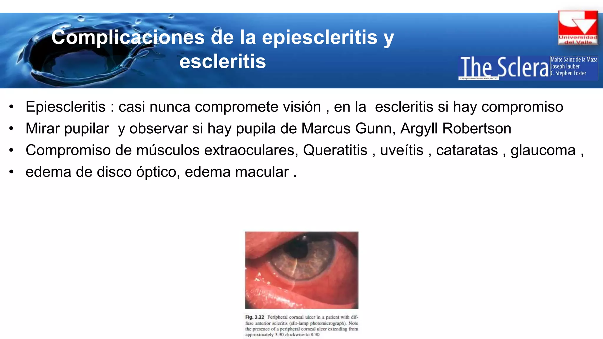 Epiescleritis y escleritis en oftalmologia