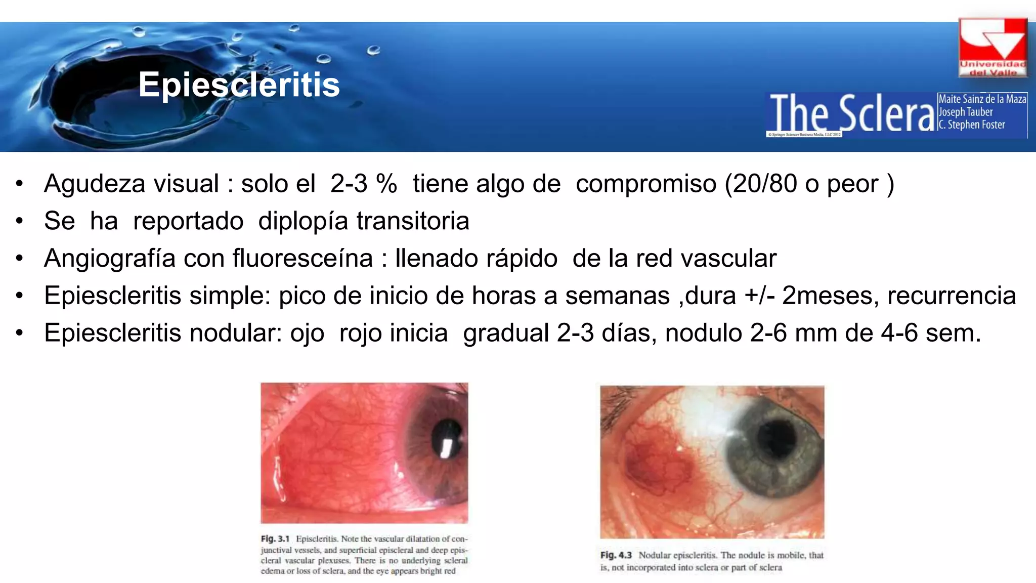 Epiescleritis y escleritis en oftalmologia